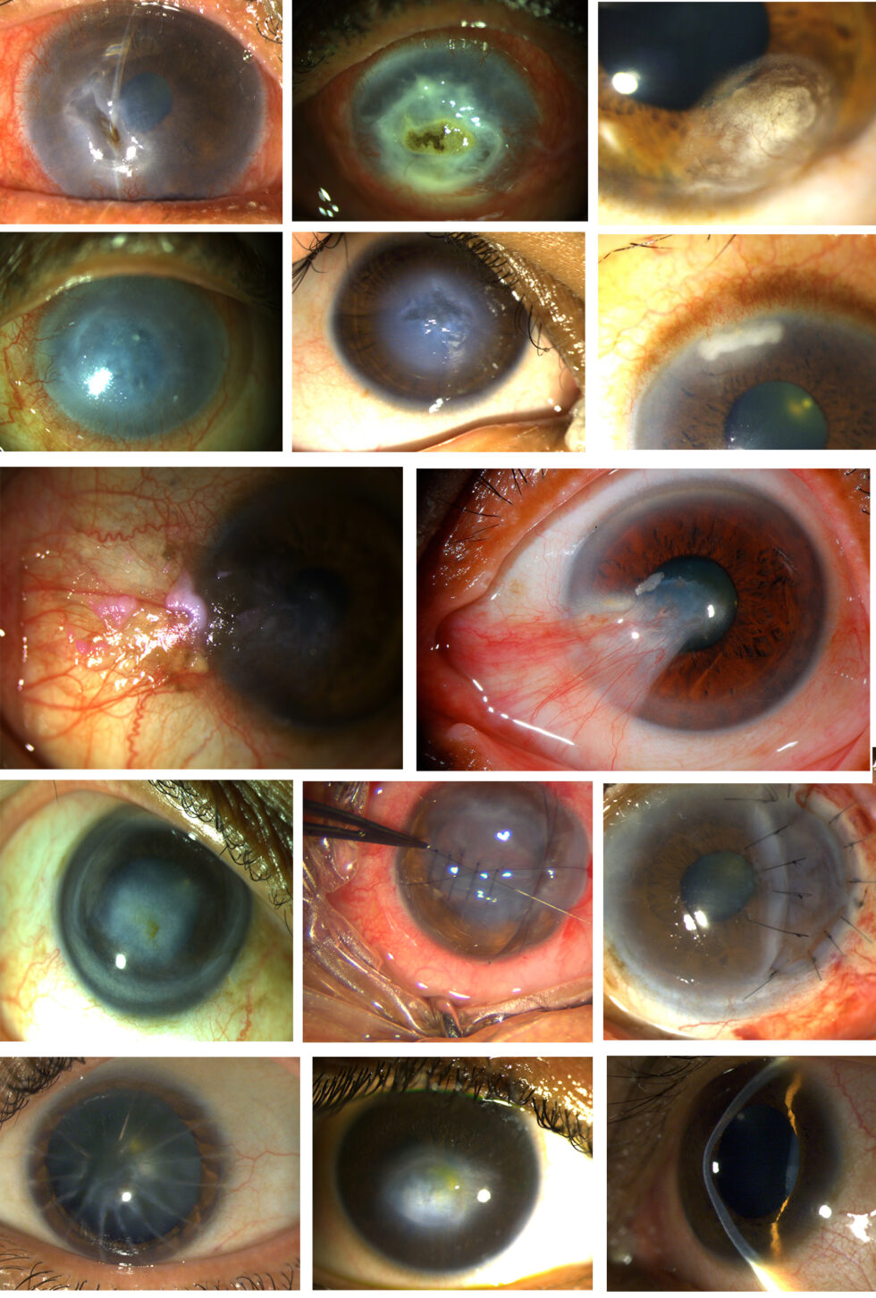 Cornea Transplant - LJ Eye Institute