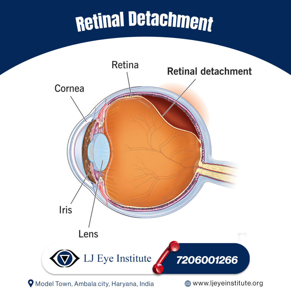 Retinal Detachment - LJ Eye Institute