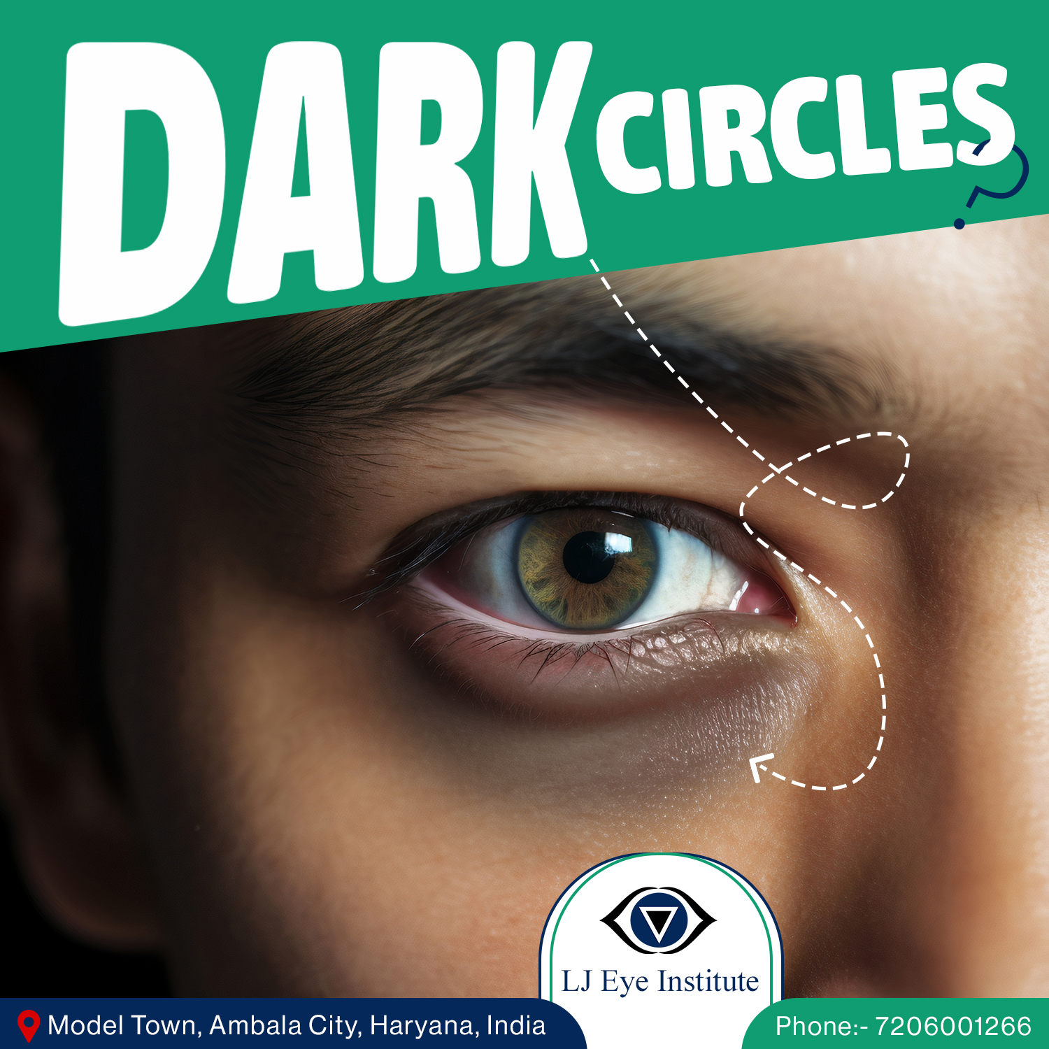 What Causes Puffy Eyes and Dark Circles Under The Eyes? - LJ Eye Institute