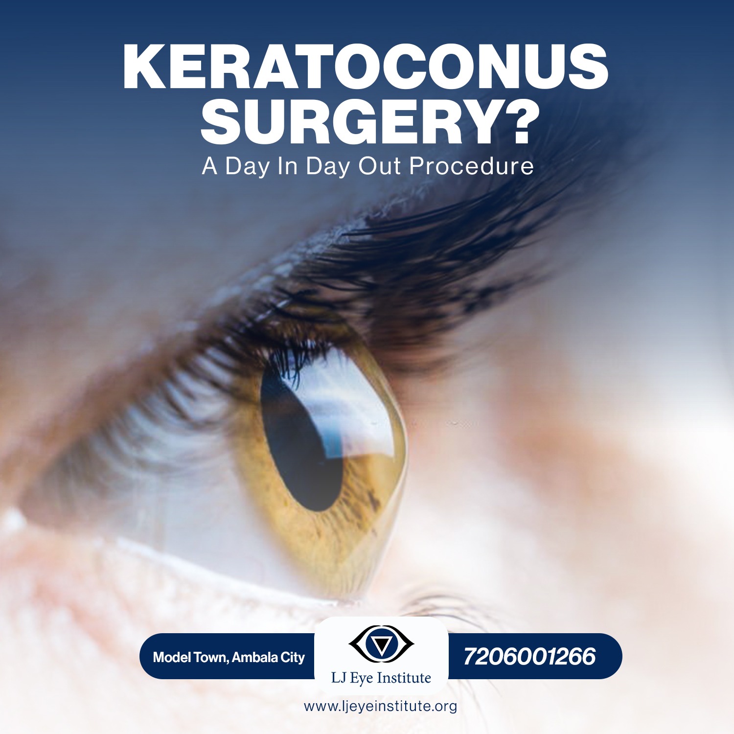 Keratoconus: Symptoms, Causes & Treatment - LJ Eye Institute