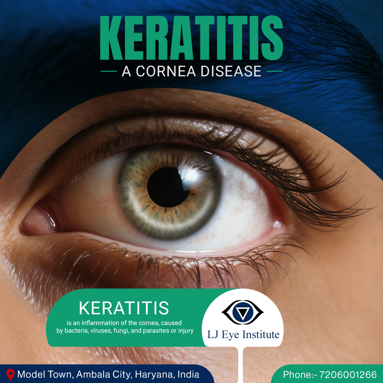 What is Keratitis? Symptoms, Types, Causes and Risks - LJ Eye Institute