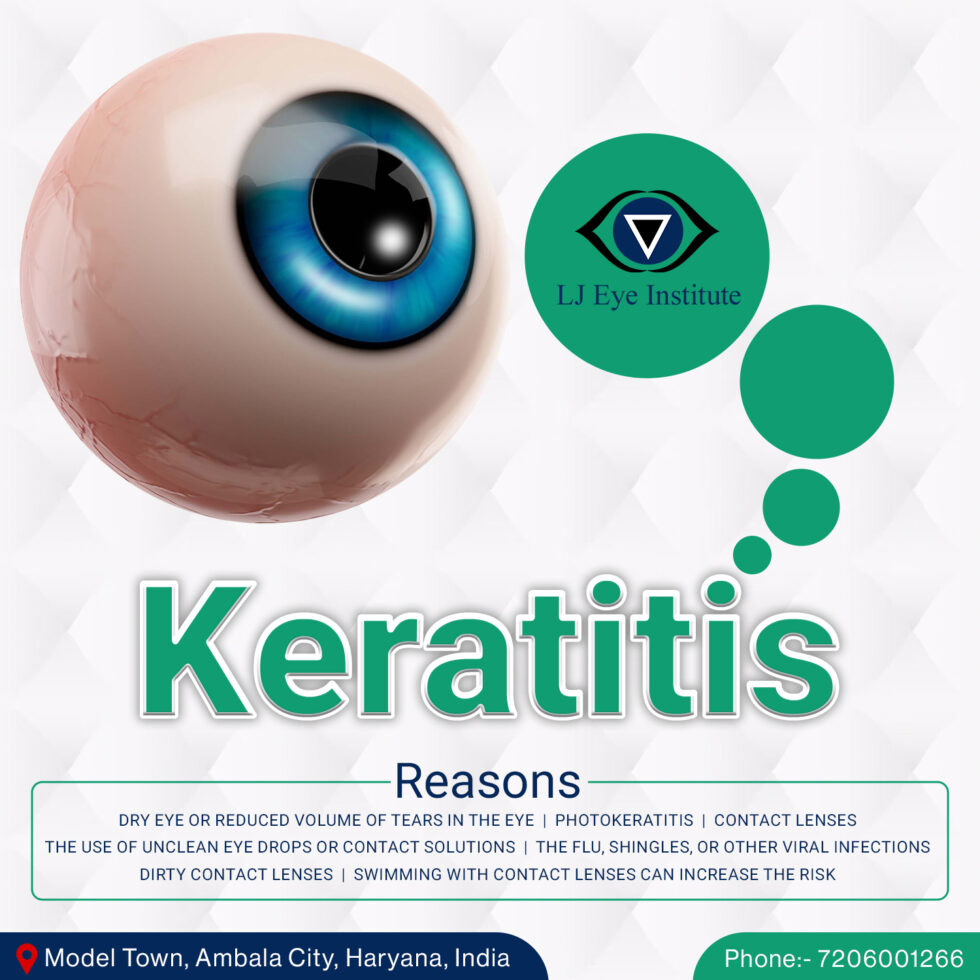 What is Keratitis? Symptoms, Types, Causes and Risks - LJ Eye Institute