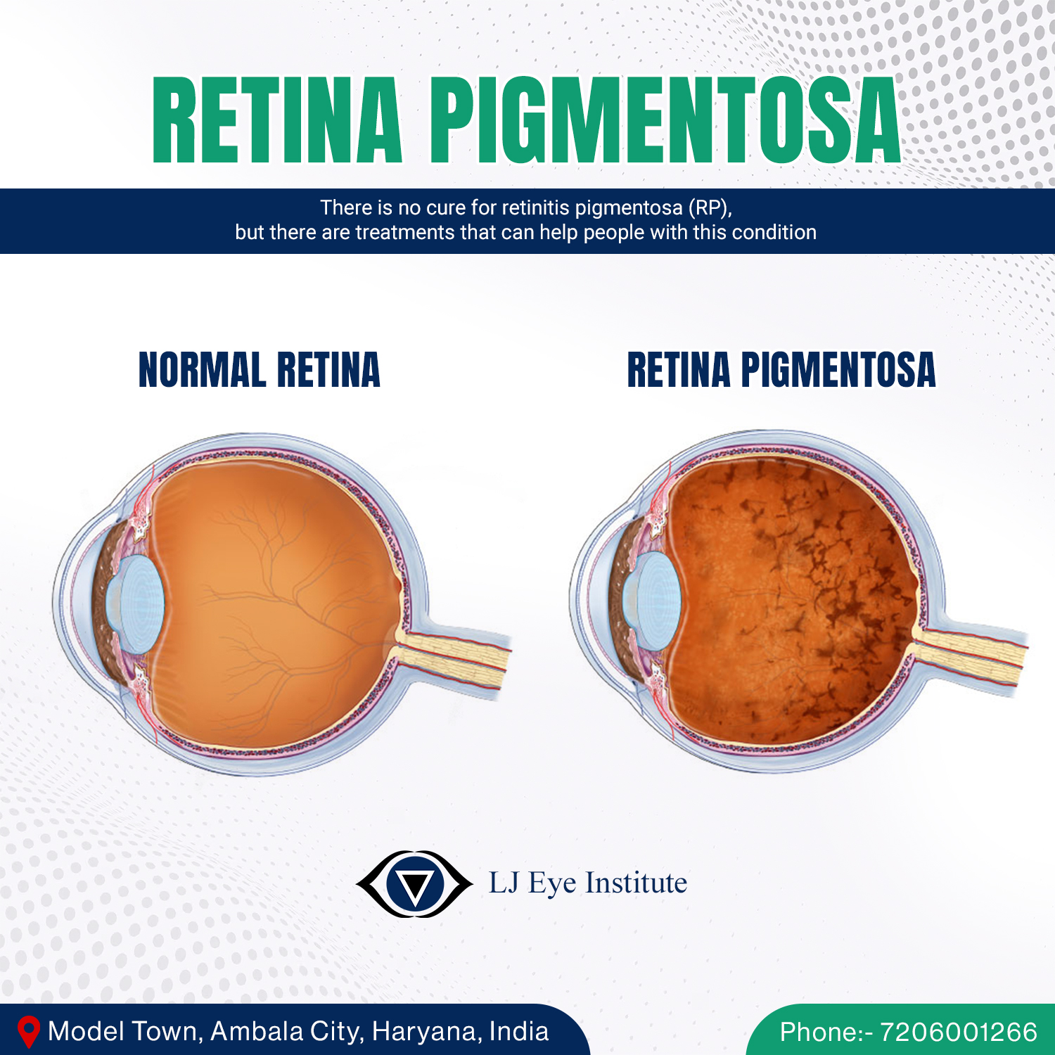 Retinitis Pigmentosa Before And After What Is Retinitis Pigmentosa?