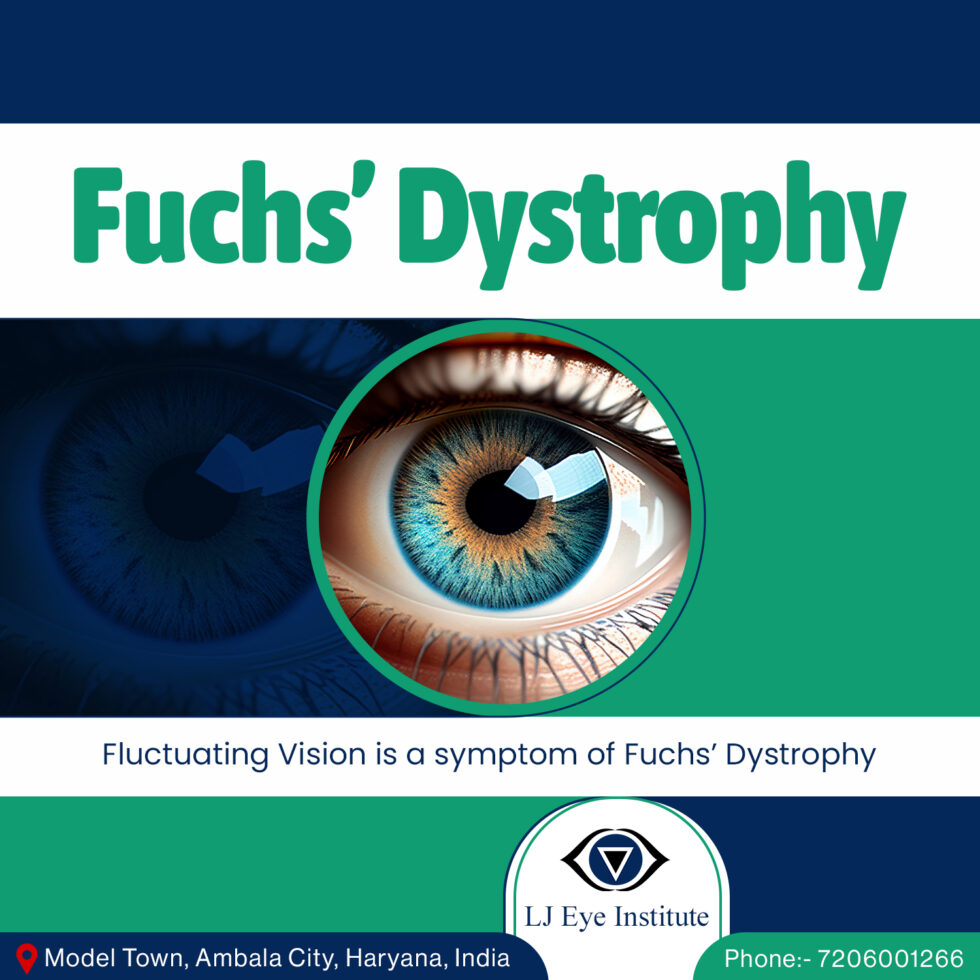 Fuchs’ Dystrophy: Early Signs and Treatment Options - LJ Eye Institute