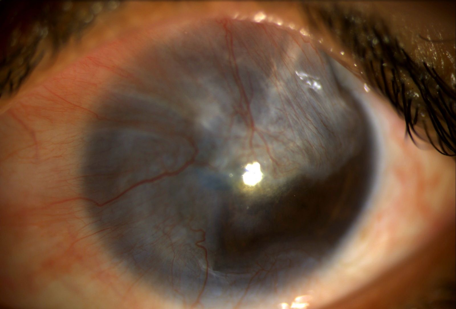 What is SLET Surgery? Who need this surgery? Best SLET Surgery in ...